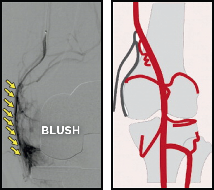 Columbus Vascular Center | Genicular Artery Embolization